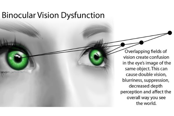 Causes Of Binocular Vision Dysfunction And Treatment